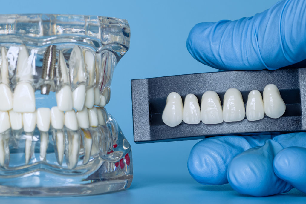 Matching Shape and Shade: The Key to Realistic Porcelain Bridges ...